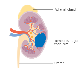 ملف:Diagram showing stage 2 kidney cancer CRUK 209.svg - المعرفة
