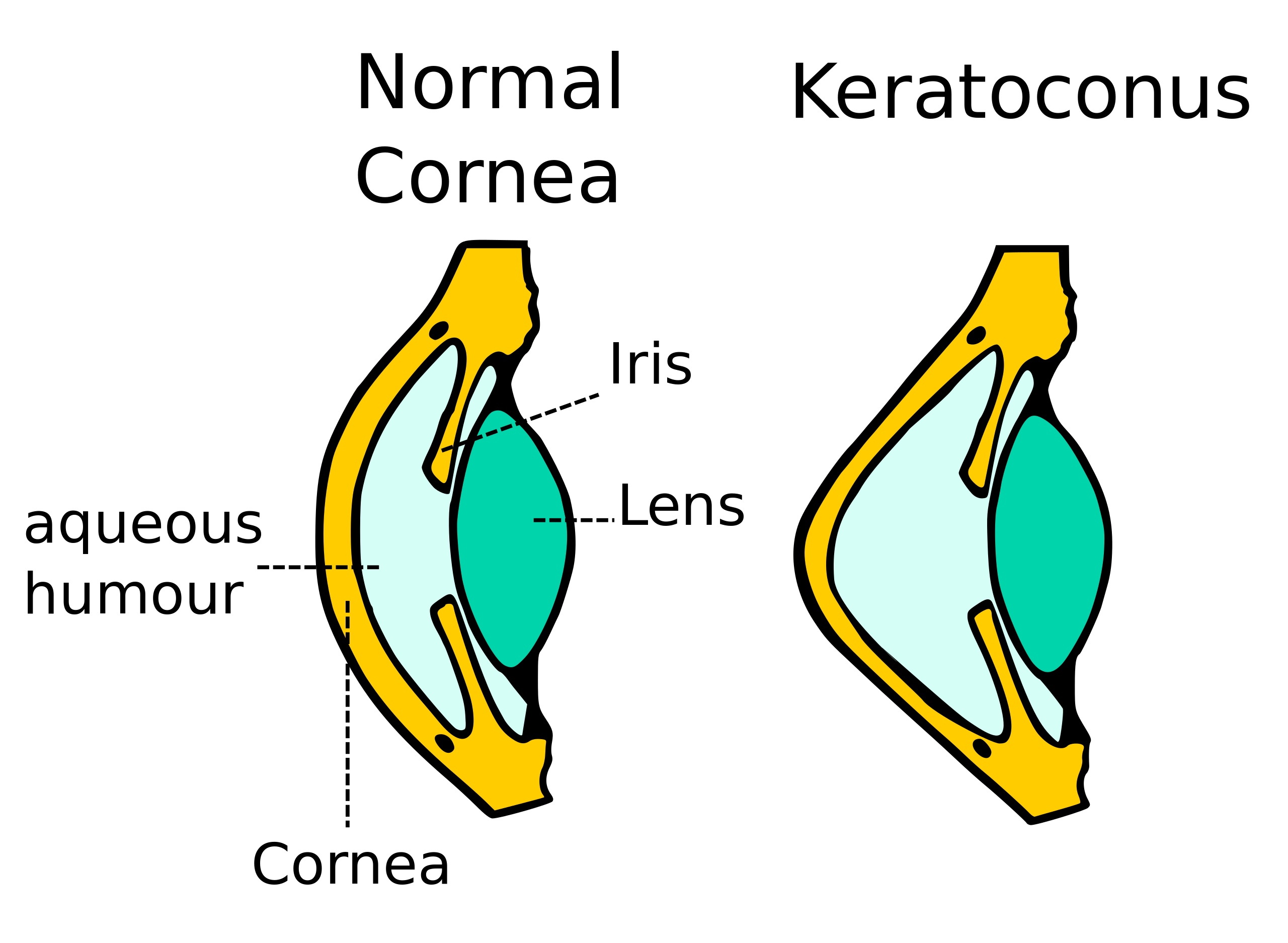 ملف:Keratoconus.svg - المعرفة