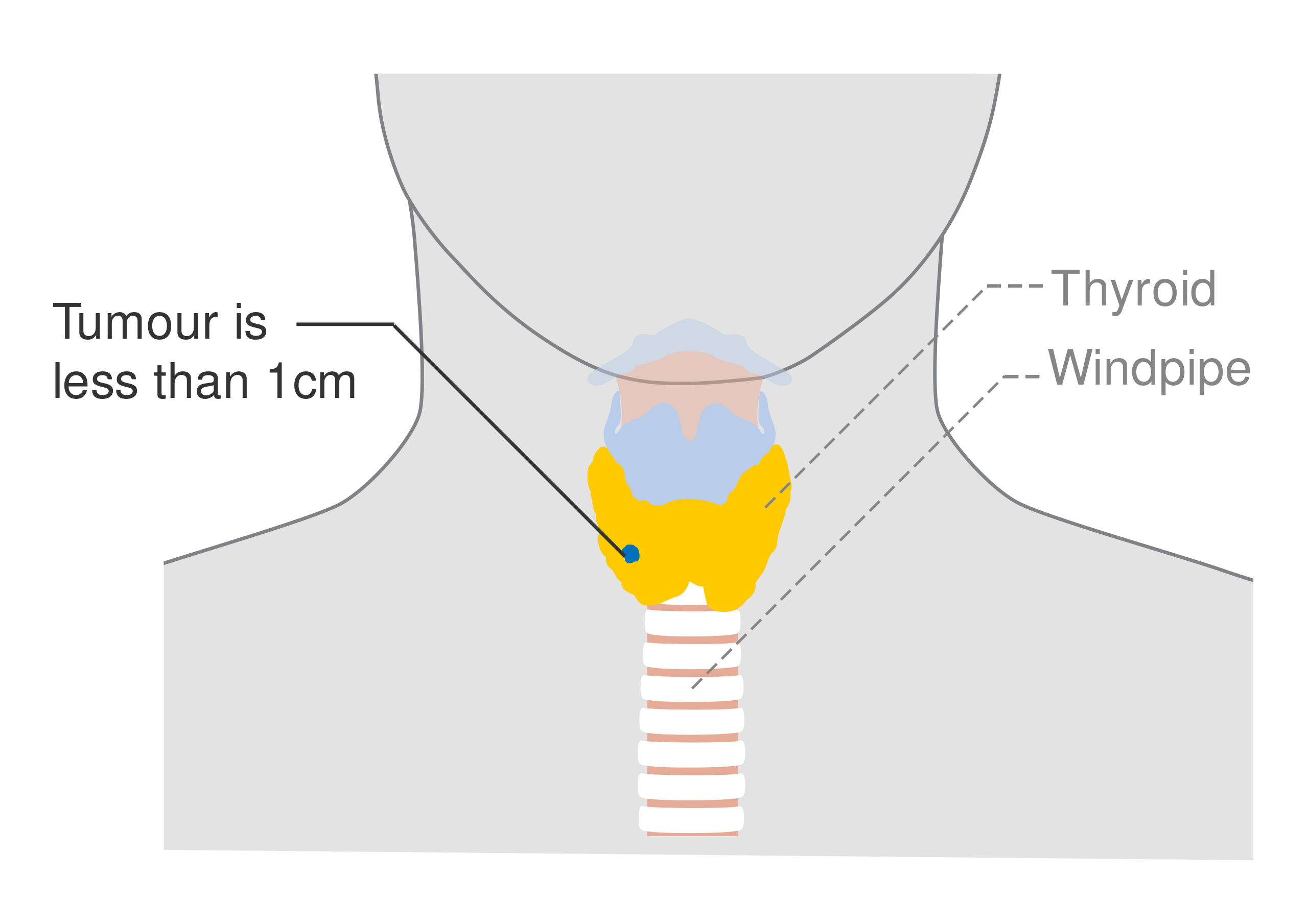 ملف:Diagram showing stage T1a thyroid cancer CRUK 250.svg - المعرفة