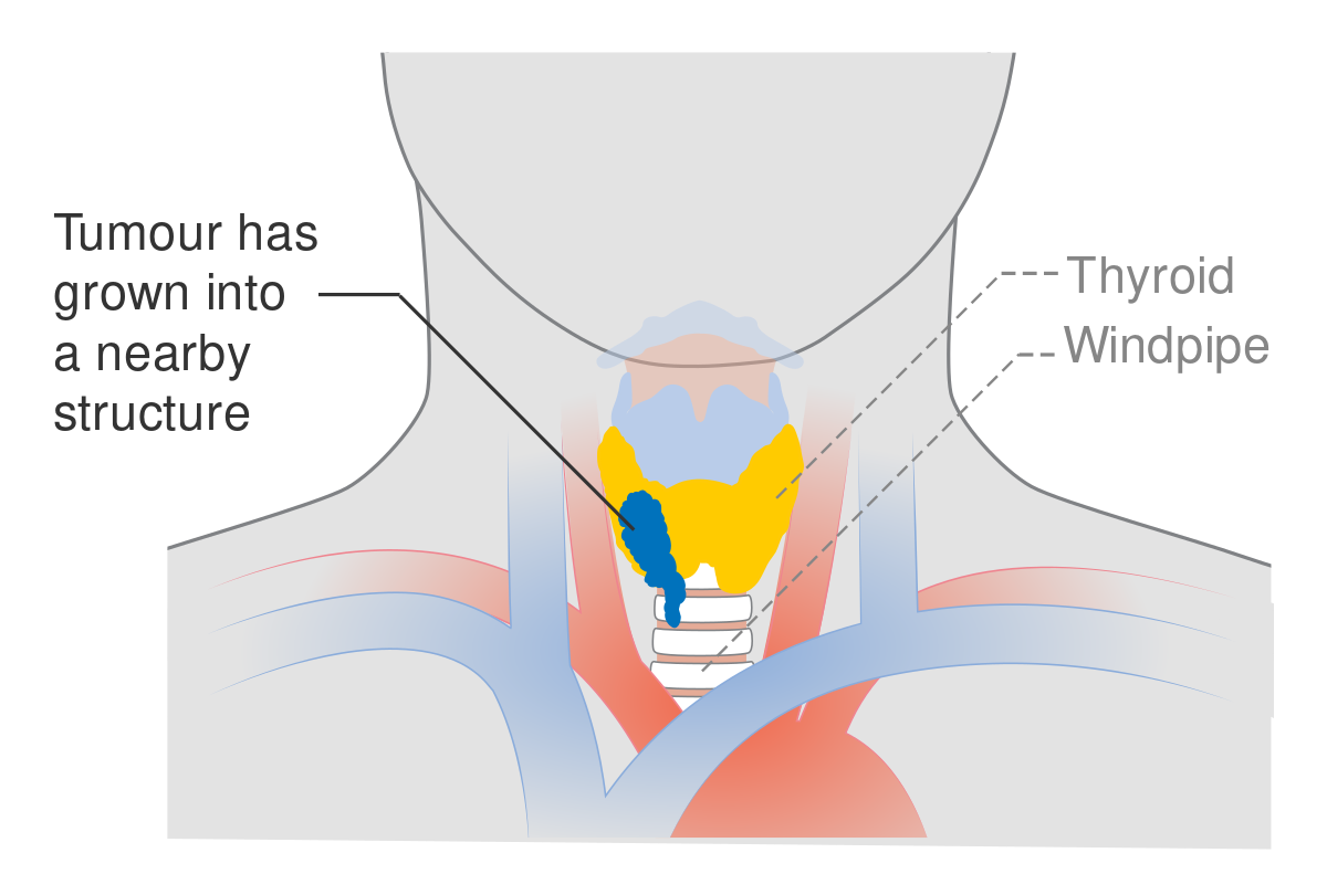 ملف:Diagram showing stage T4a thyroid cancer CRUK 272.svg - المعرفة