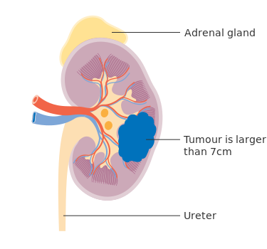 ملف:Diagram showing stage 2 kidney cancer CRUK 209.svg - المعرفة